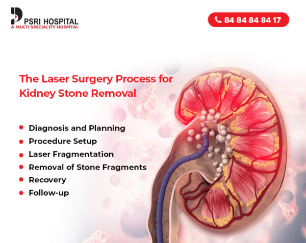 A Full Guide on Kidney Stone Removal Process – Laser Treatment
