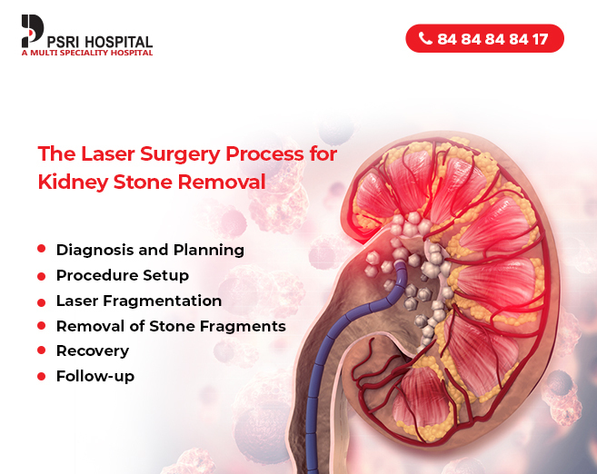 A Full Guide On Kidney Stone Removal Process Laser Treatment A Full Guide On Kidney Stone Removal Process Laser Treatment